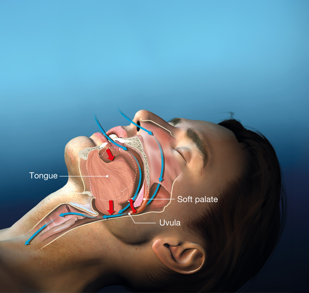 Snoring / Sleep Apnea | Dr Kenny Pang